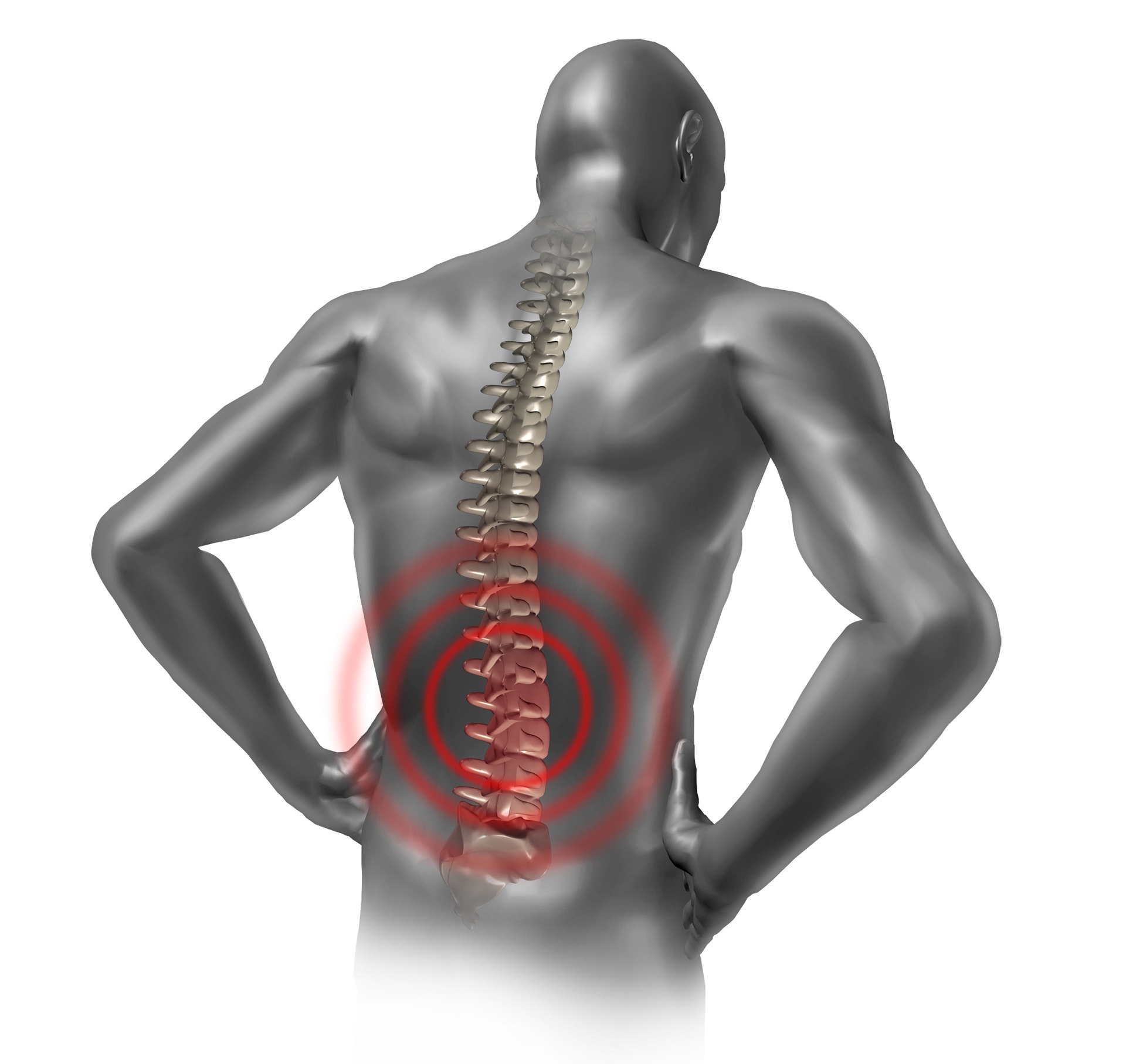 Spondylosis in St. Louis, MO & Granite City, IL | Interventional Pain ...